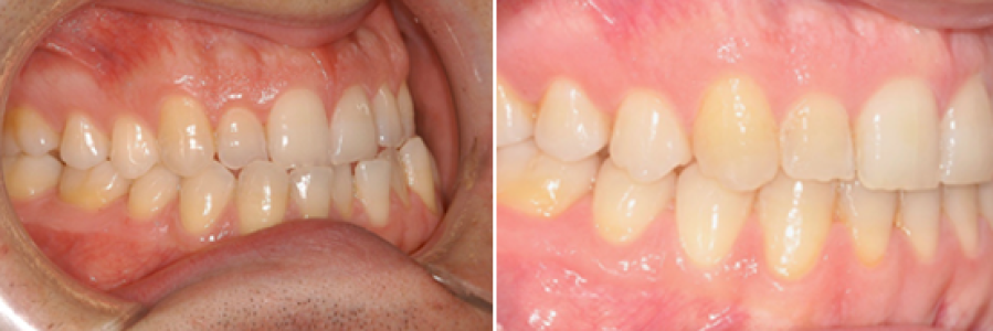 Distalización de Arcadas Mandibulares | Caso de Éxito | Clínica Ojeda ...